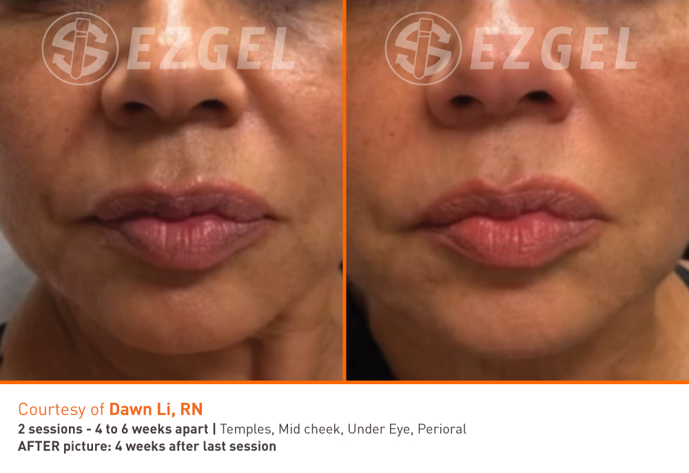 ezGEL PRF delivers proven results for Nasolabial Folds Rejuvenation