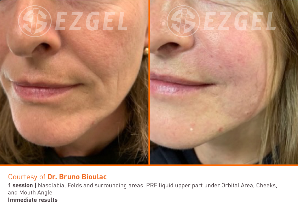 ezGEL PRF delivers proven results for Nasolabial Folds Rejuvenation